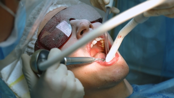 Professional Teeth Cleaning Method Air Flow by Aeroshot | VideoHive