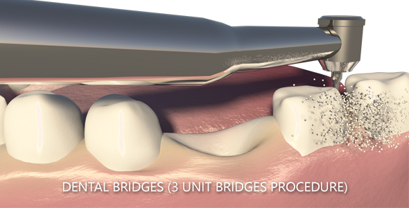 Dental Bridges (3 Unit Bridges Procedure) by madi7779 | VideoHive